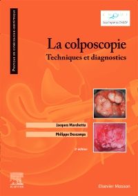 La colposcopie | Livre | 9782294787904
